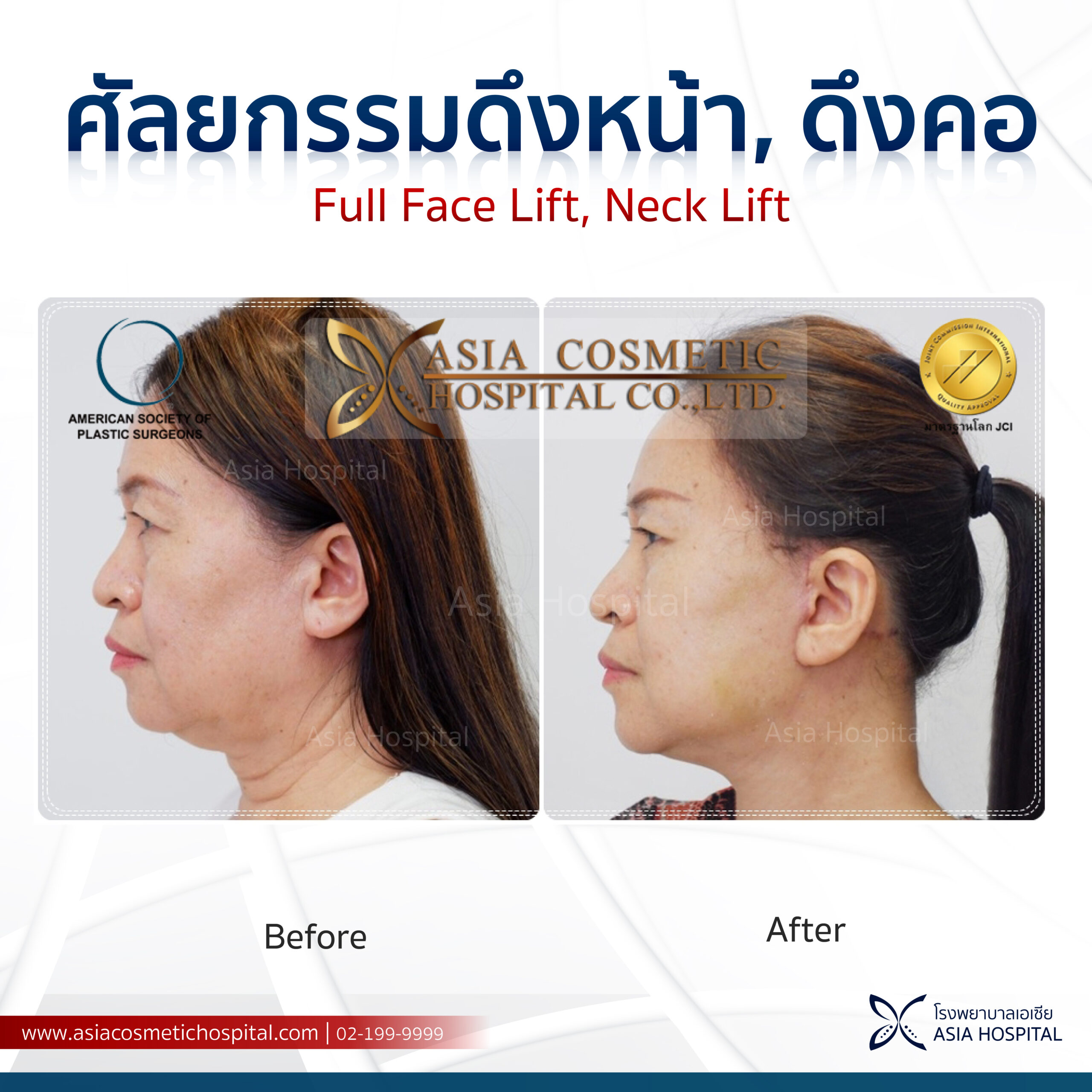 ดึงหน้า Full face lift / ดึงคอ Neck lift | Asia Cosmetic Hospital